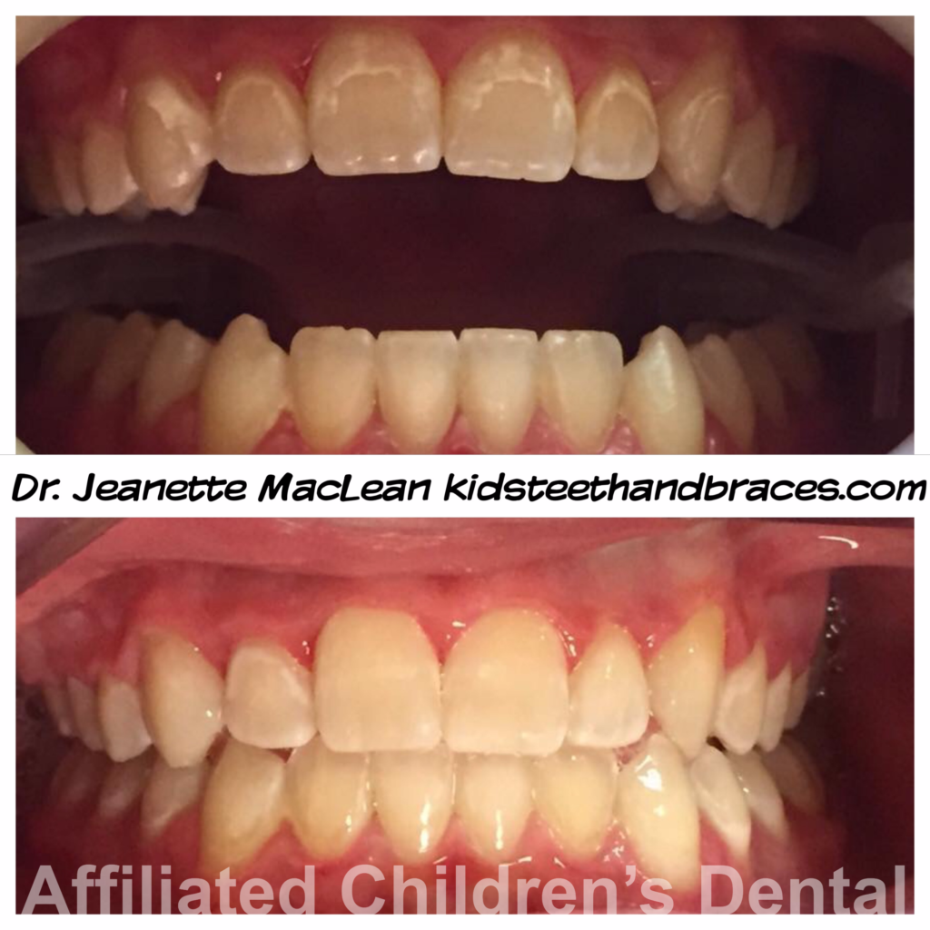 Infiltración de resina Icon (ICON) | Affiliated Children's Dental ...