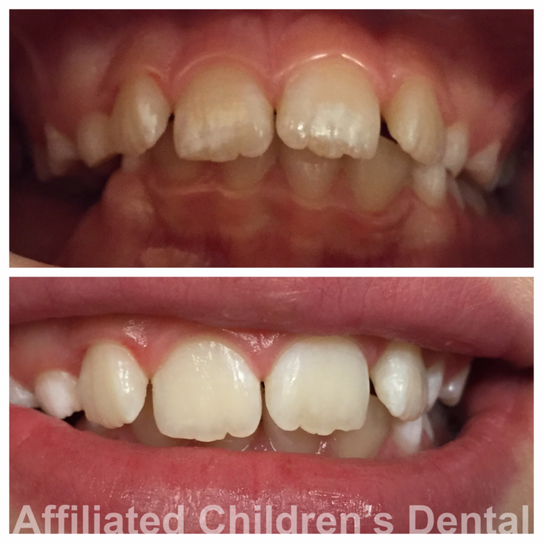 Infiltración de resina Icon (ICON) | Affiliated Children's Dental ...